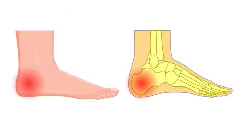 Wat is hielspoor? - Fysiotherapie & Fitness